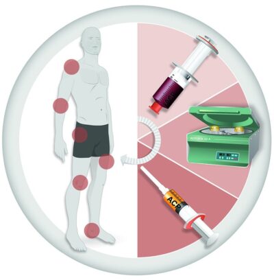 ACP-behandling: Regenerativ terapi til smerter og skader - Hjørring ...